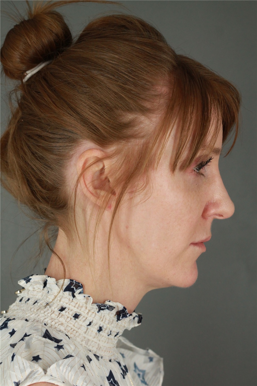 Rhinoplasty Before and After Photos by Patti Flint, MD; Scottsdale, AZ ...