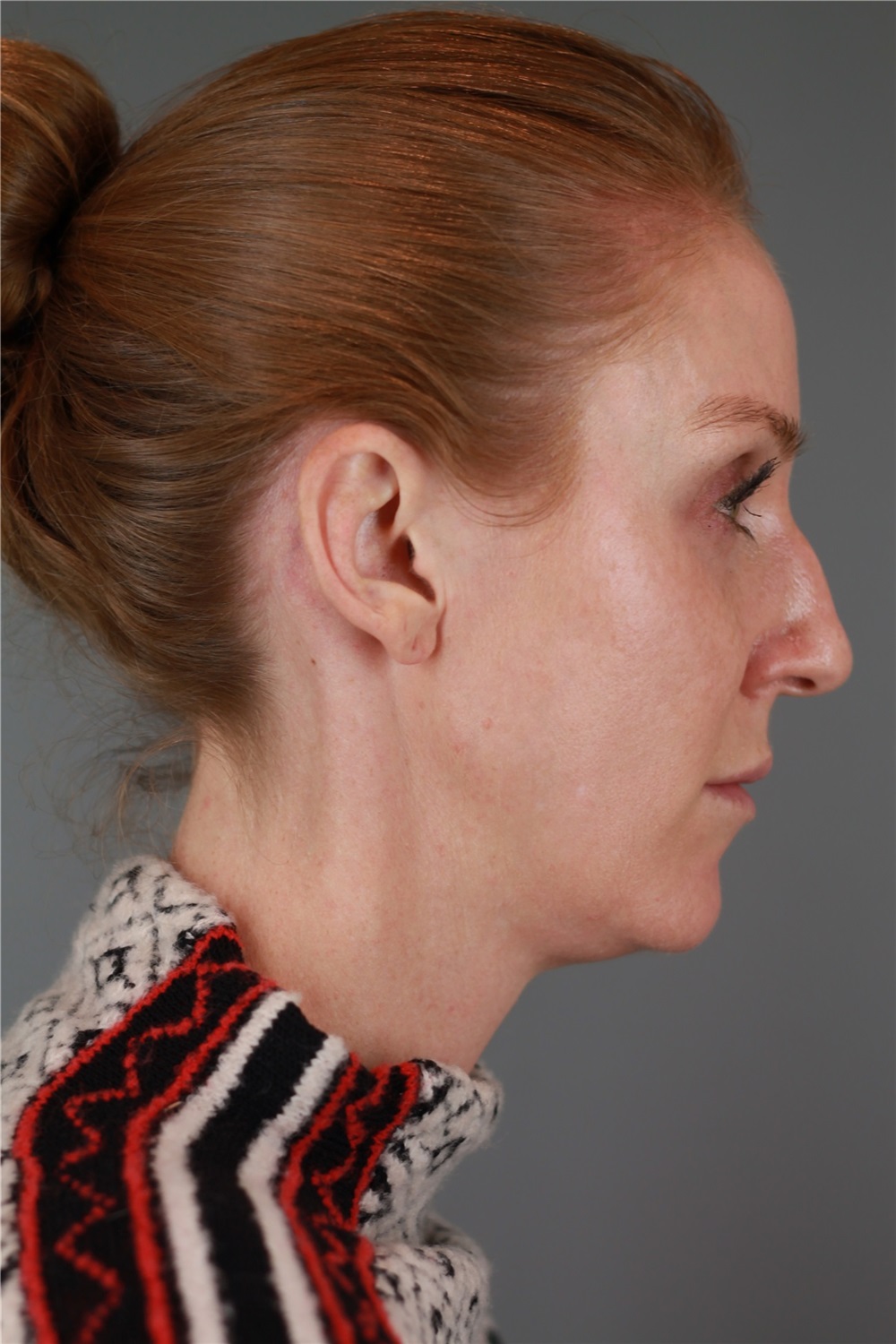 Rhinoplasty Before and After Photos by Patti Flint, MD; Scottsdale, AZ ...