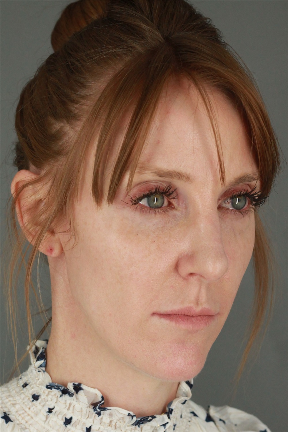 Rhinoplasty Before and After Photos by Patti Flint, MD; Scottsdale, AZ ...