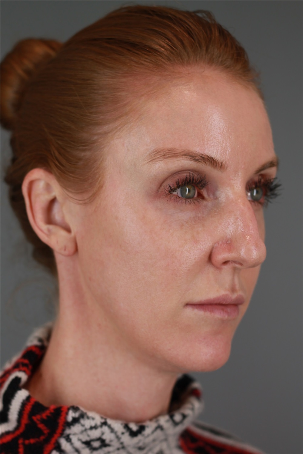 Rhinoplasty Before and After Photos by Patti Flint, MD; Scottsdale, AZ ...