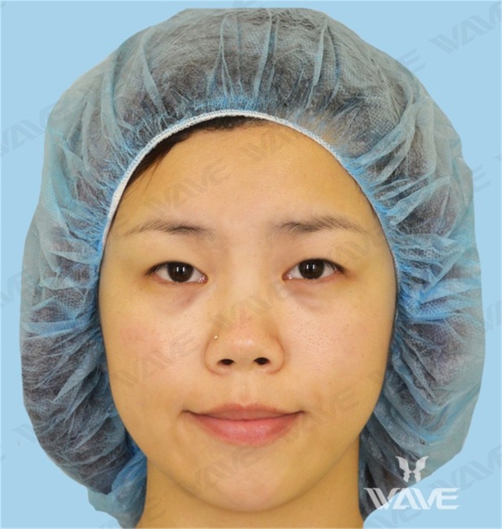 Eyelid Surgery Before and After Photos by Peter Lee, MD, FACS; Los ...