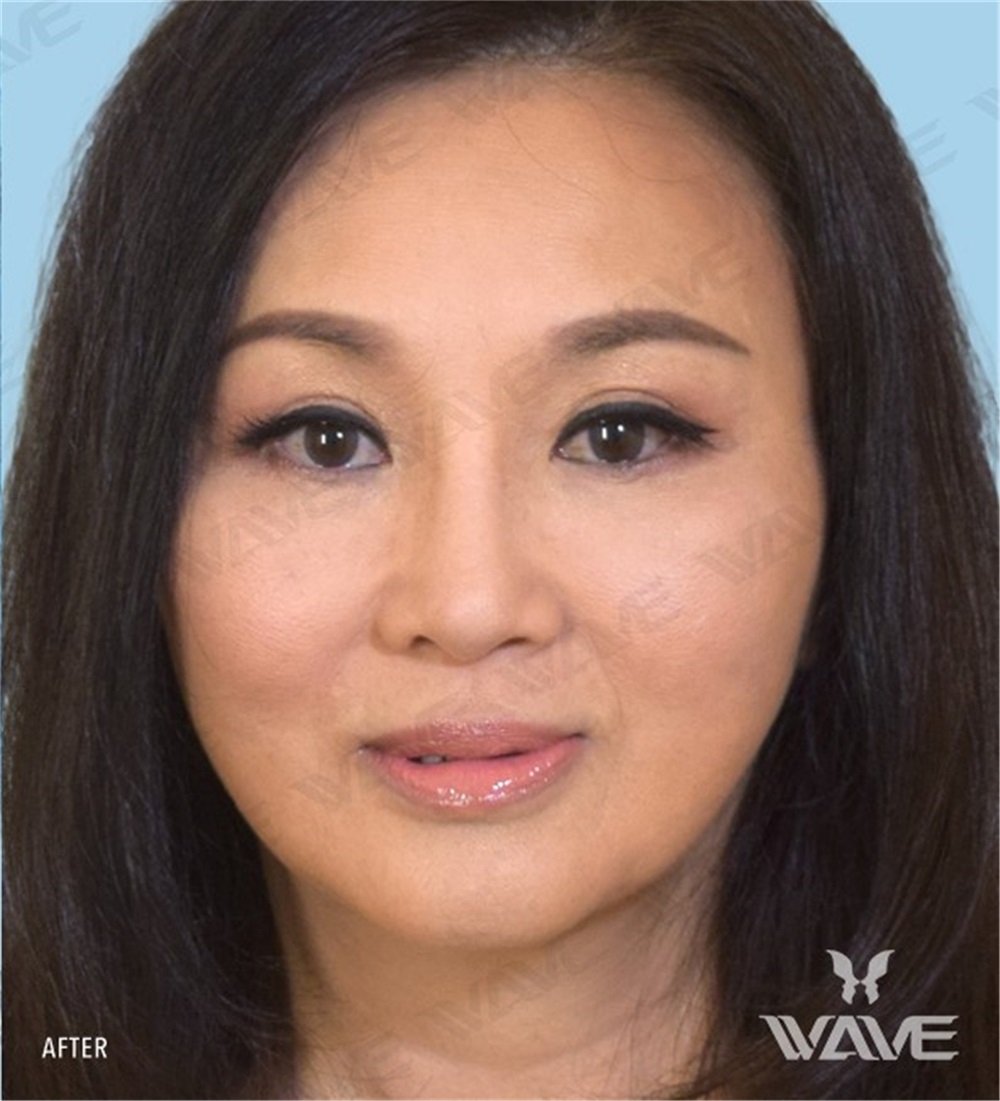 Facelift Before and After Photos by Peter Lee, MD, FACS; Los Angeles ...