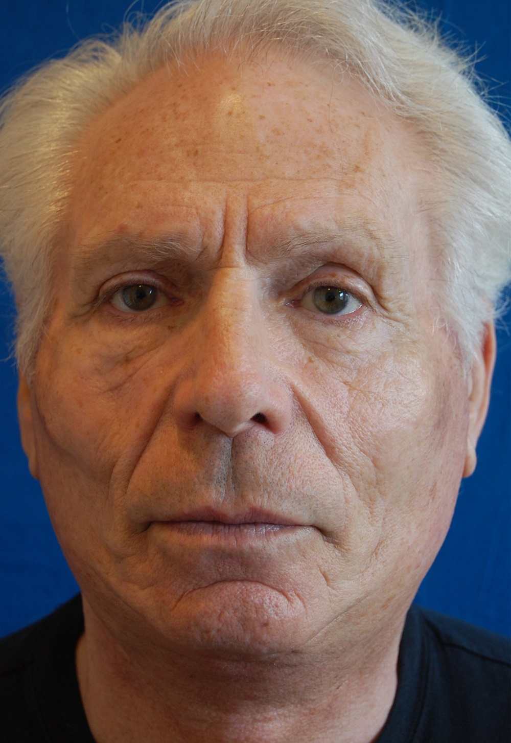 Facelift Before and After Photos by Gregory Albert, MD; Boca Raton, FL ...