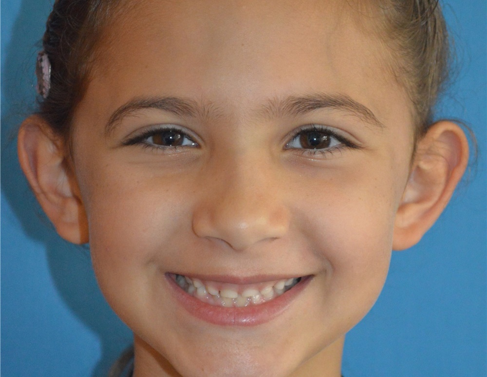 Ear Surgery Before and After Photos by Gregory Albert, MD; Boca Raton ...