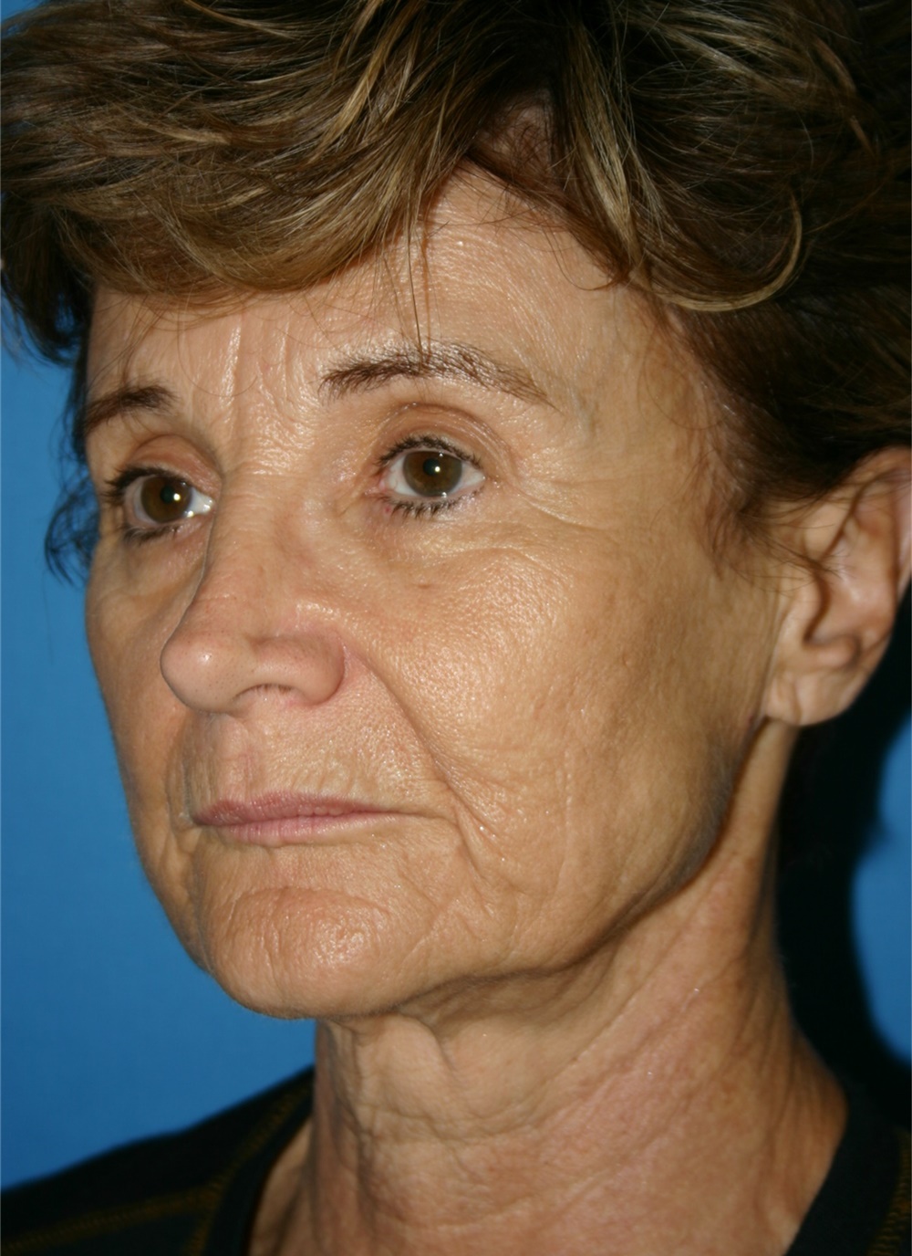 Facelift Before and After Photos by Gregory Albert, MD; Boca Raton, FL ...