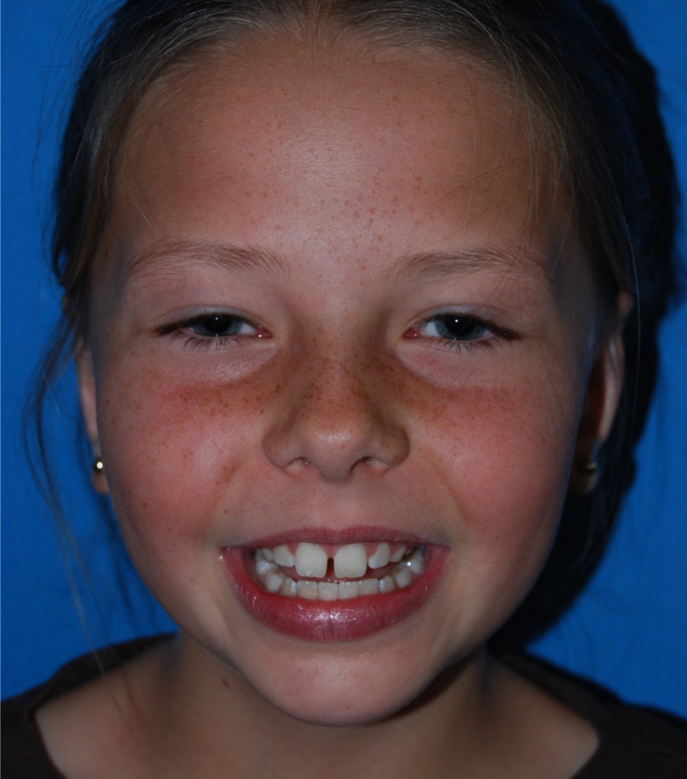 Ear Surgery Before and After Photos by Gregory Albert, MD; Boca Raton ...