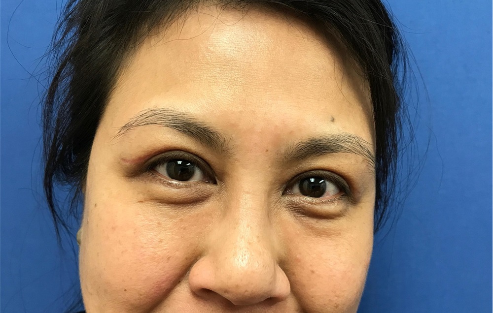 Eyelid Surgery Before and After Photos by Daniel Sherick, MD; Ypsilanti ...