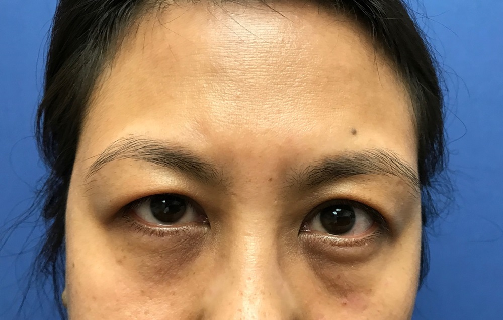 Eyelid Surgery Before and After Photos by Daniel Sherick, MD; Ypsilanti ...