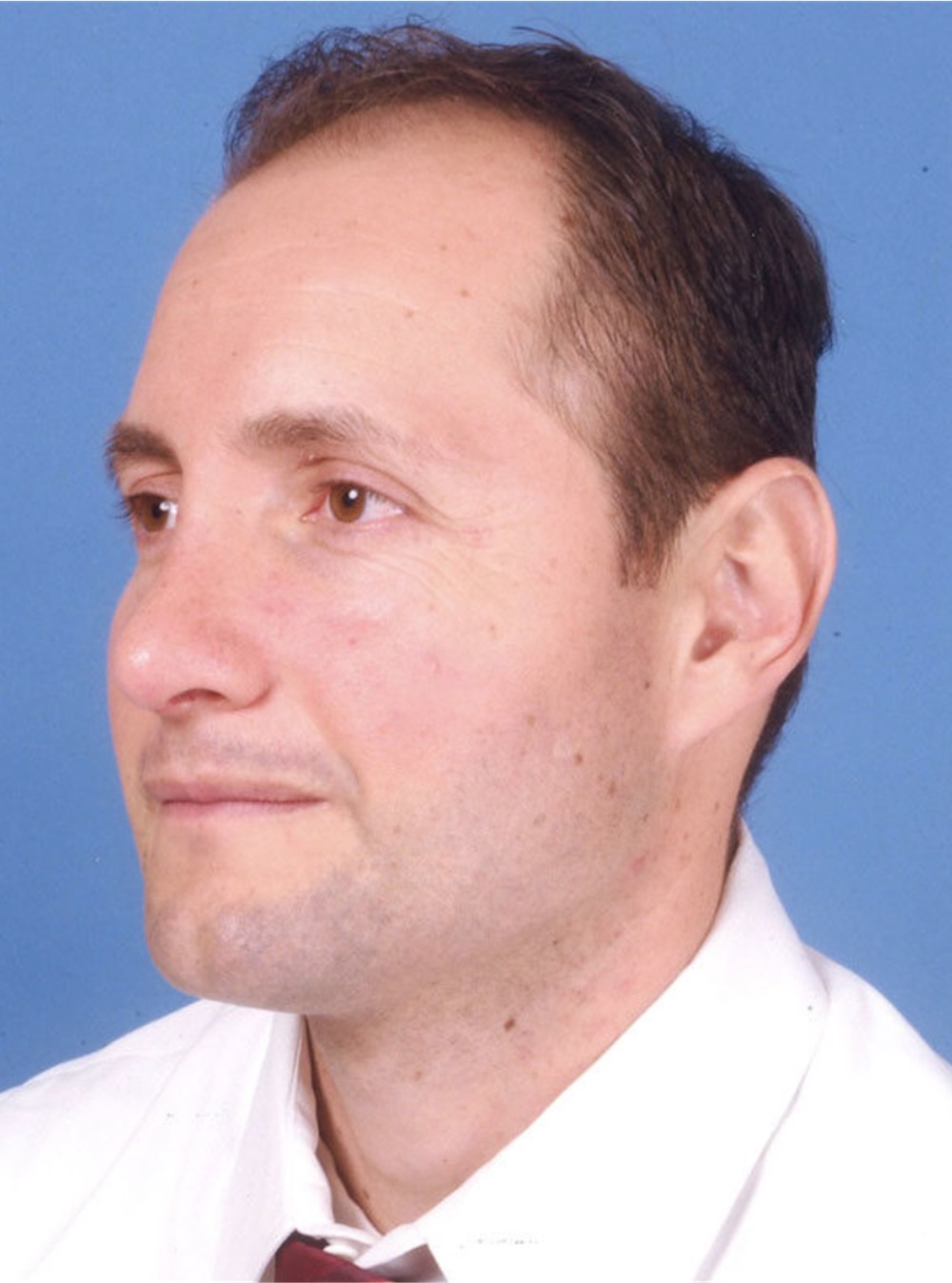 Rhinoplasty Before and After Photos by James Bradley, MD, FACS; Lake ...